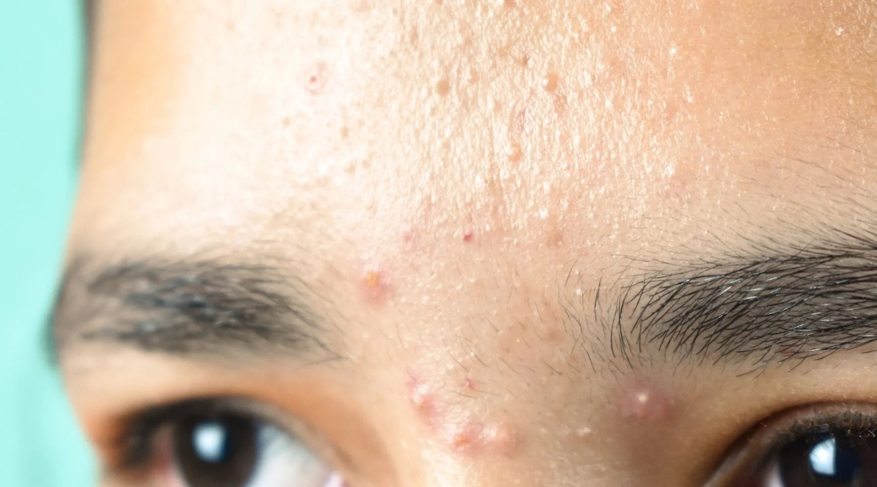 How to Get Rid of Whiteheads – clearskinvitamins